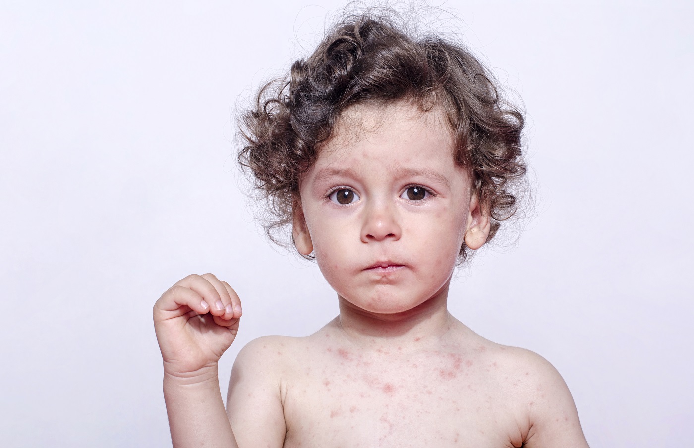 Measles is on the rise globally | News & Stories | Dartmouth Health ...